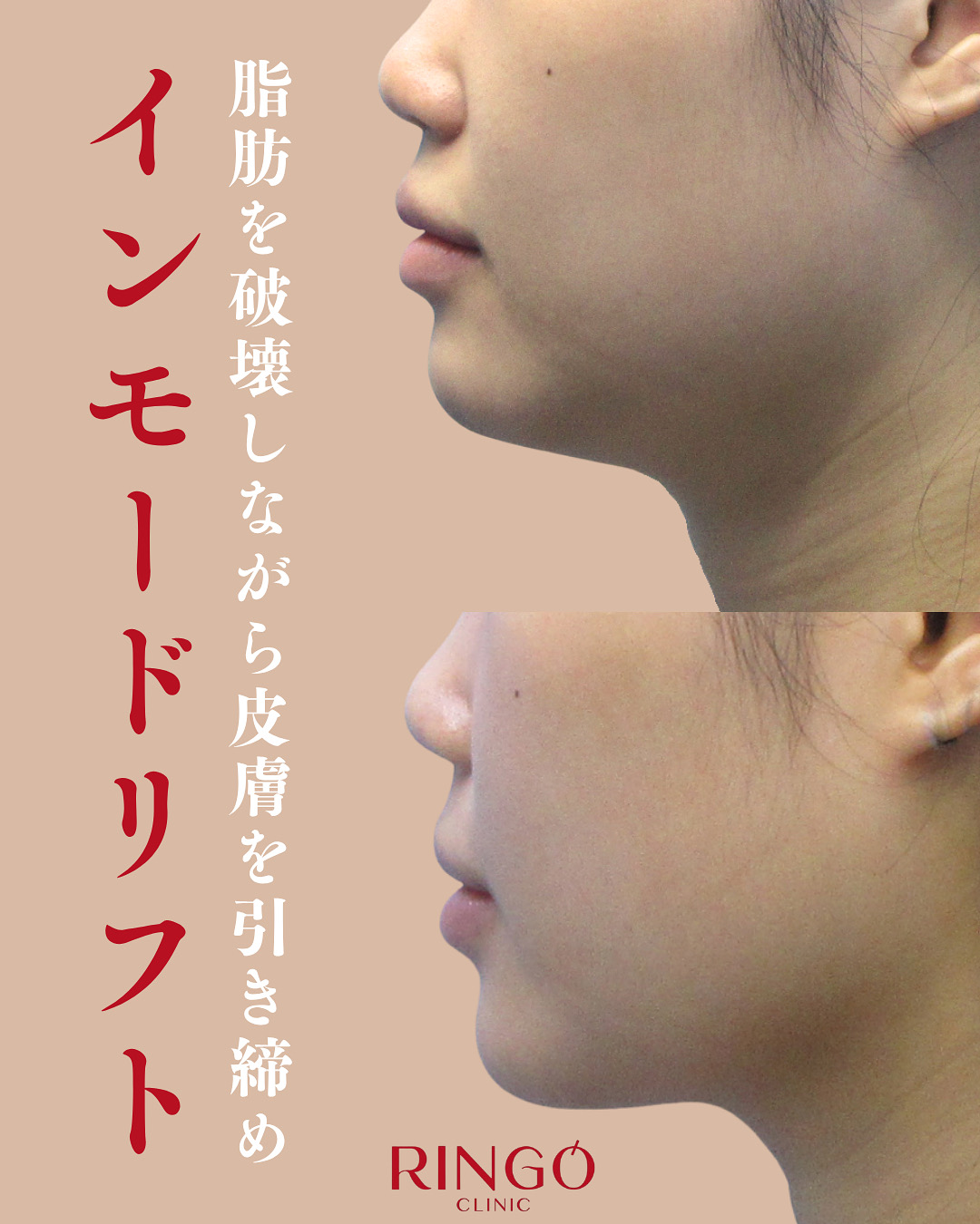 インモードとは？効果と仕組み・痛み・ダウンタイムを解説｜MiniFX・Forma - Ringo Clinic